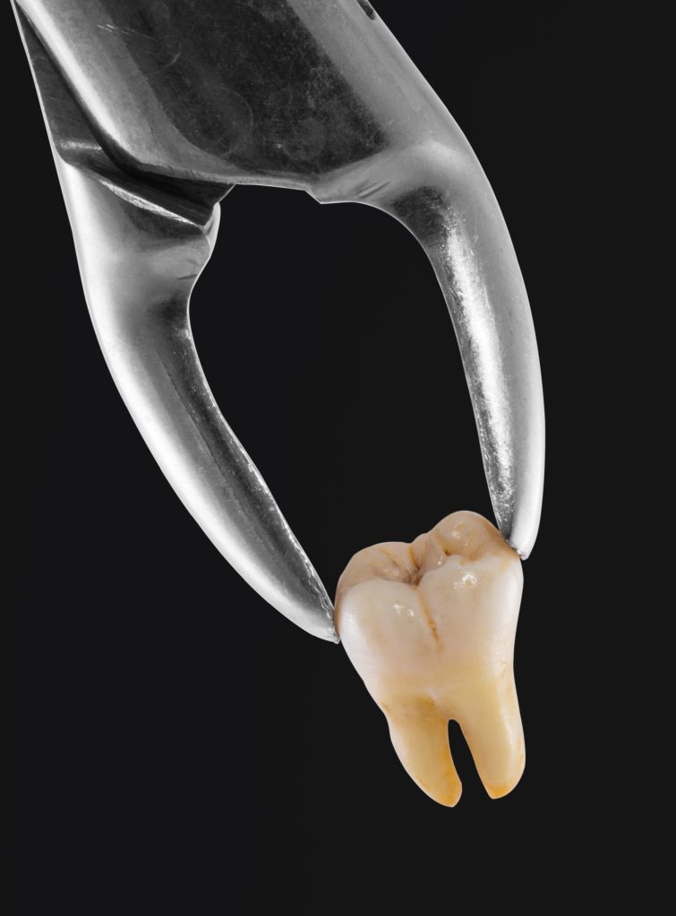 When Is Tooth Extraction for Baby Teeth the Right Choice? - The Dental ...